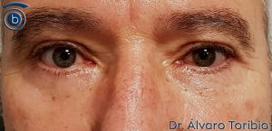 Blefaroplastia Inferior - Blefaroplastia y Cirugía de Párpados | Dr ...