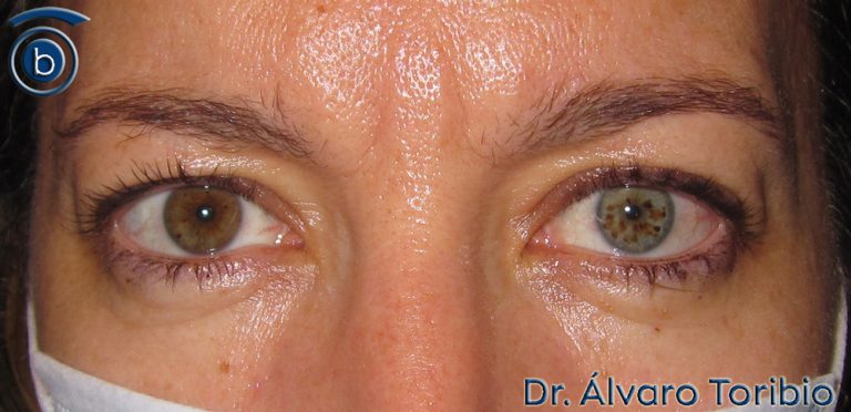 Blefaroptosis - Blefaroplastia y Cirugía de Párpados | Dr. Toribio