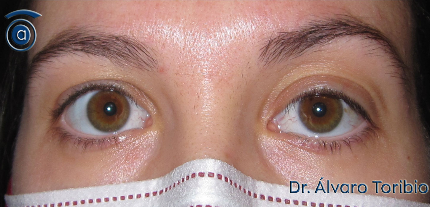 Galería - Blefaroplastia y Cirugía de Párpados | Dr. Toribio