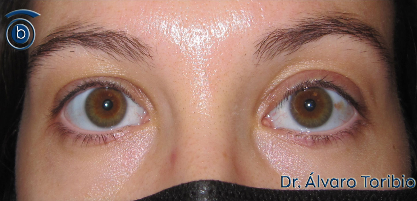 Galería - Blefaroplastia y Cirugía de Párpados | Dr. Toribio