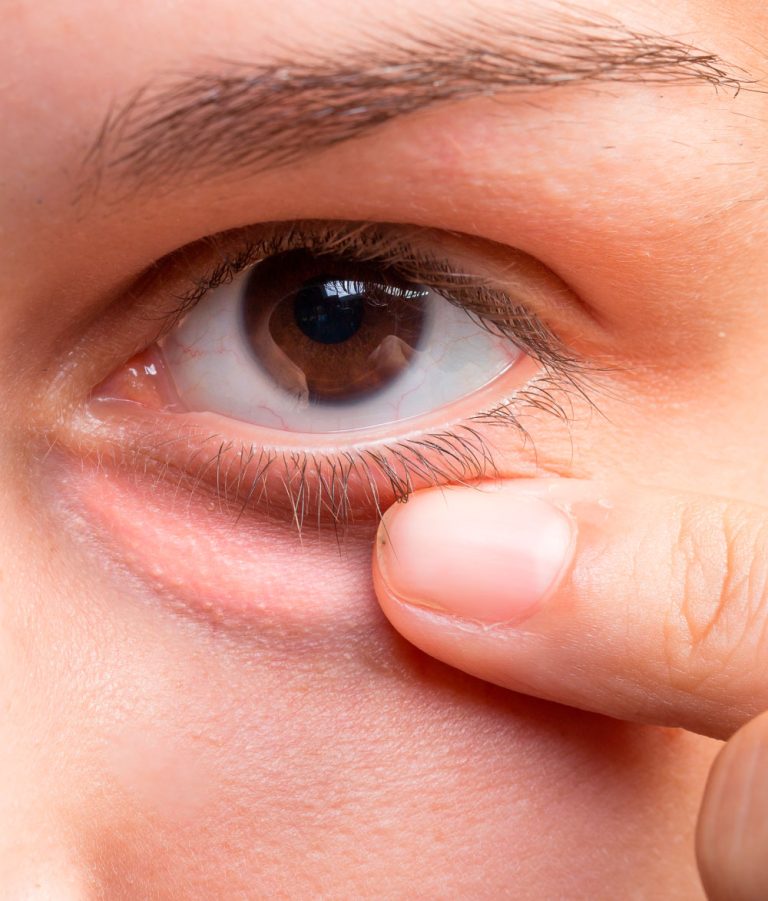Patología - Blefaroplastia y Cirugía de Párpados | Dr. Toribio