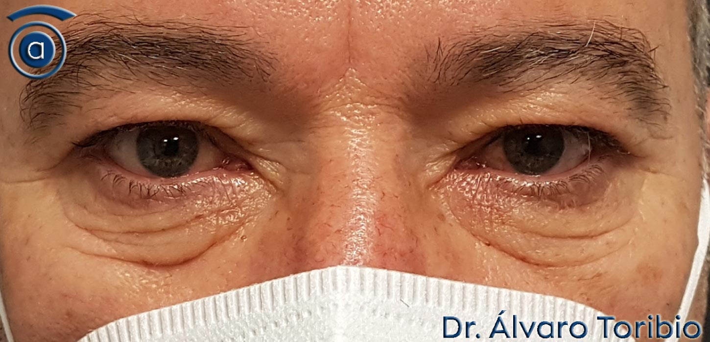 Galería - Blefaroplastia y Cirugía de Párpados | Dr. Toribio